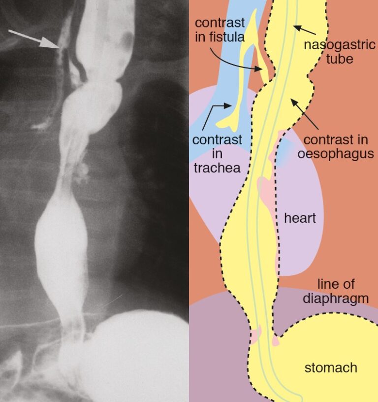 Recurrent fistula – TOFS | OA/TOF Support