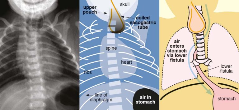 Long gap OA - delayed primary anastomosis – TOFS | OA/TOF Support
