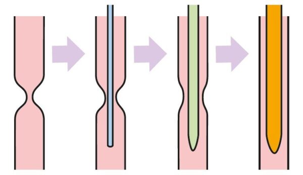 Oesophageal dilatation – TOFS | OA/TOF Support